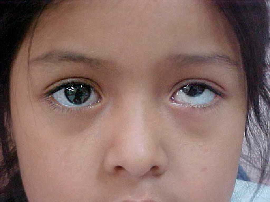 Schielen Strabismus ist auch eine Augenfehlstellung